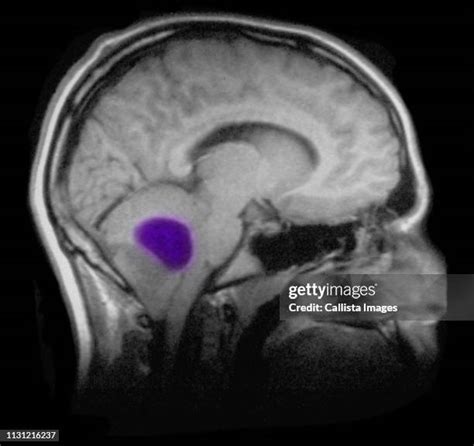 Astrocytoma Photos And Premium High Res Pictures Getty Images
