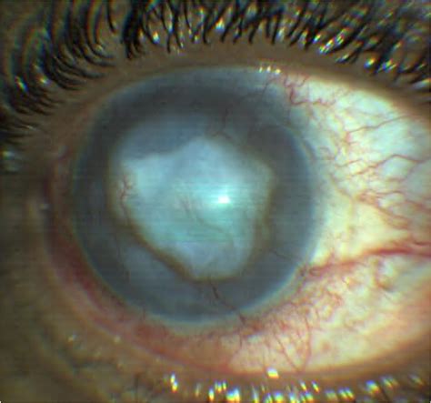 Bullous Keratopathy Viewpoint