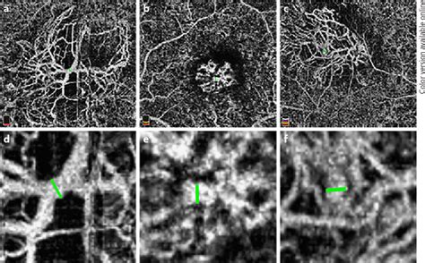 Figure 1 From The Comparison Of Morphologic Characteristics Of Type 1 And Type 2 Choroidal