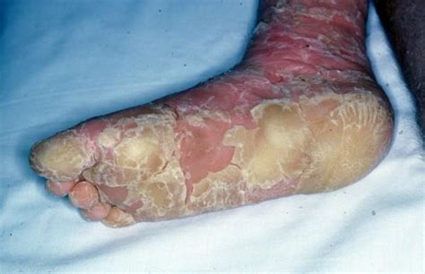 Epidermolytic Hyperkeratosis Types Causes Symptoms And Prognosis
