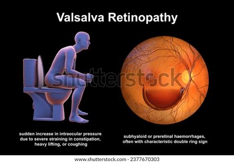 Valsava Retinopathy Preretinal Hemorrhage Caused By Stock Illustration