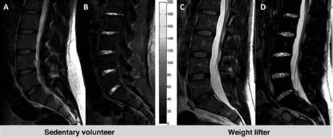 Imaging Technologies Of The Spinal Discs Anesthesia Key