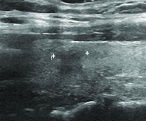Description Solid Hypoechogenic Nodule With Imprecise Limits