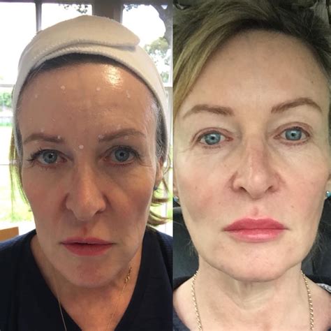 I Was Long Overdue Some Fillers And Dr Ruthie Aesthetics