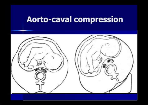 Obsterics Anesthesia Procedures And Complicationspdf