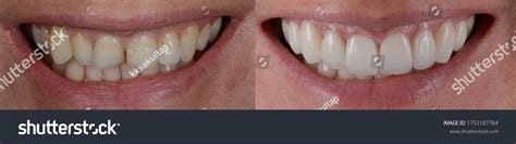 Chiclet Teeth How To Discuss