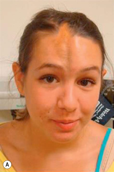 Idiopathic Progressive Hemifacial Atrophy Clinical Tree