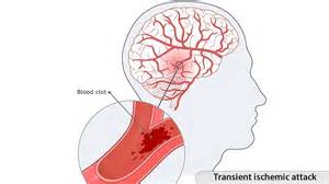 First Time Tias Linked With Long Term Cognitive Decline