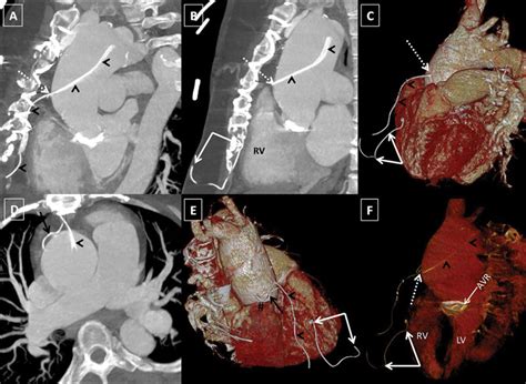 Ct Angiography Images Showing Intra Aortic Migration Of One Of The