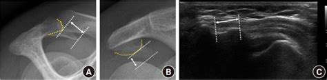 Evaluation Of Acromial Spur Using Ultrasonography Pmc