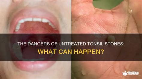 The Dangers Of Untreated Tonsil Stones What Can Happen Medshun