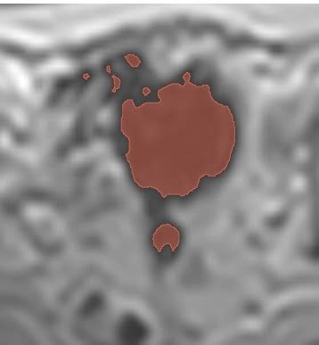 Segmentation With Spatial Resolution Different Than The Source Volume