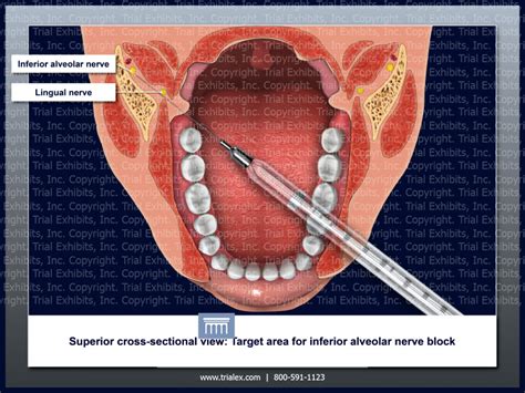 Inferior Alveolar Nerve Block Trialexhibits Inc