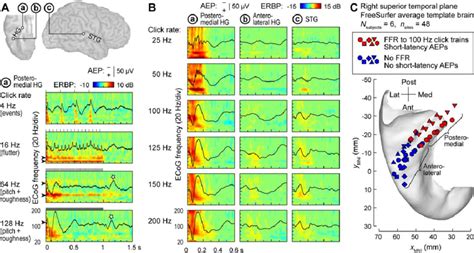 Auditory Cortical Regions Differ In Their Capacity To Track Temporal