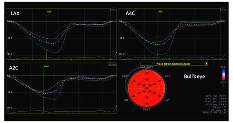 Automated Function Imaging Afi Of Left Ventricular 2 D Strain Of