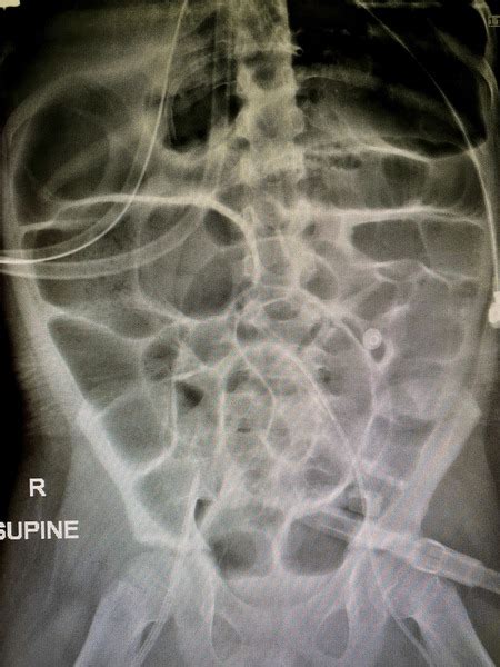 ภาพ ภาพสต็อก วัตถุ 3 มิติและเวกเตอร์เกี่ยวกับ Bowel Dilatation 263