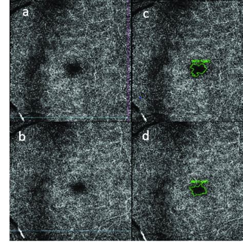 Swept Source Optical Coherence Tomography Angiography Images Showing A