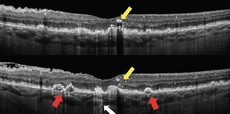 intraretinal hyperreflective foci on b scans precede retinal atrophy