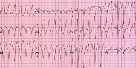 Cardiac Arrest Shockable And Non Shockable Rhythms Cardiac