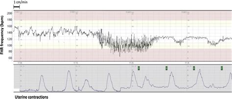 Continuous Cardiotocography During Labour Analysis 53 Off