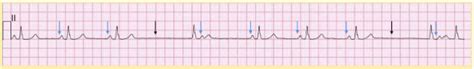Topic Sinoatrial Node Exit Block Av Blocks Arrhythmia Course
