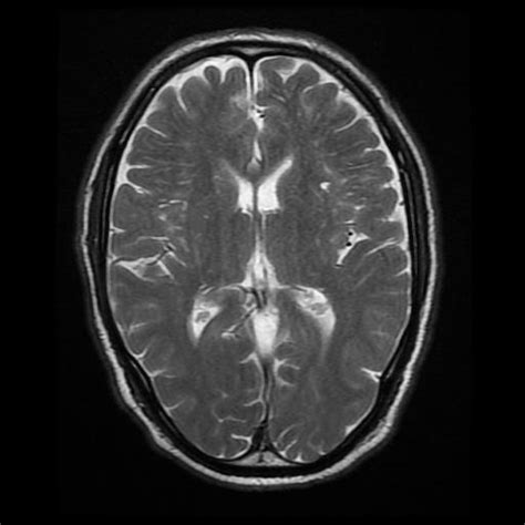 Pontine Infarct Image Radiopaedia Org