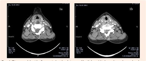 Figure 1 From Management Of Esophagus Perforation As A Late Term