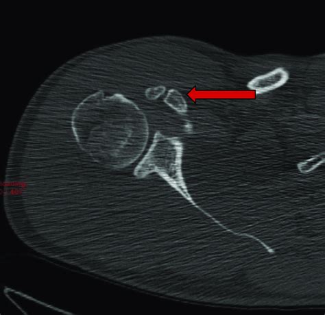 Axial Computed Tomography Scan Of A Right Shoulder Showing A Coracoid