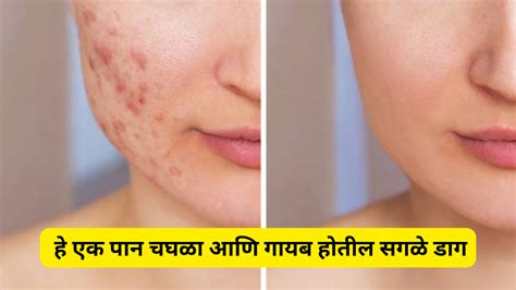 हे एक पान चघळा आणि गायब होतील सगळे डाग धब्बे चेहरा होईल तजेलदार