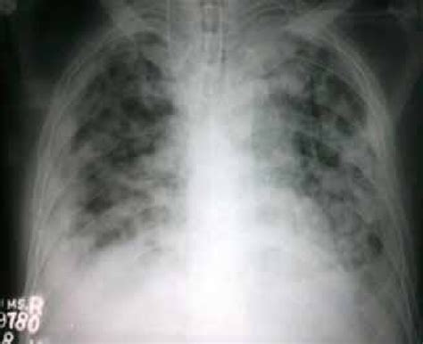 Chest Radiograph Showing Multiple Ill Defined Nodular Opacities