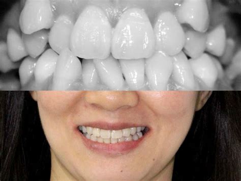 Răng khểnh ảnh hưởng xấu đến vệ sinh răng miệng Invisalign Việt Nam