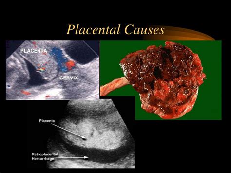 Ppt Intrauterine Growth Restriction Powerpoint Presentation Free