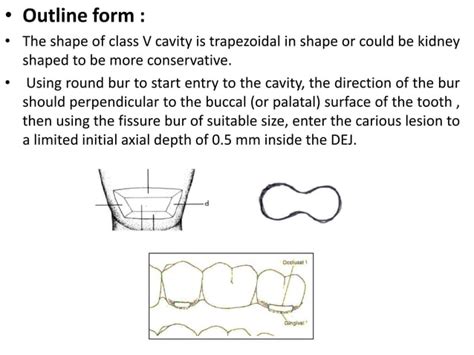 Class V And Vi Amalgam Cavity Preparations Pptx