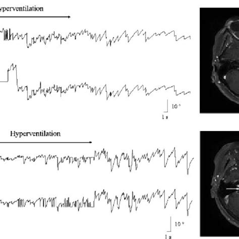 Hyperventilation Induced Nystagmus In Two Patients With Acoustic