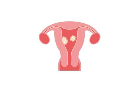 Survey Finds Most Women With Uterine Fibroids Are Offered