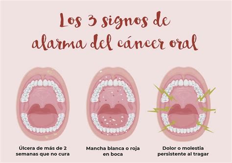 CÁncer Oral Y Sus Signos De Alarma