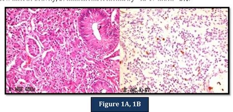 Figure From PROGNOSTIC ROLE OF KI INDEX AND MITOTIC INDEX IN NEUROENDOCRINE TUMORS OF