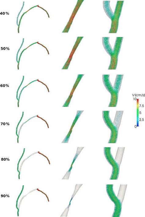Velocity Field At Diastole Case P2 For Each Degree Of Stenosis The Download Scientific