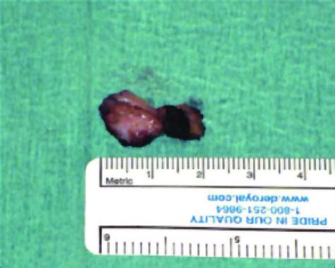 Macroscopic Aspect Of The Excised Lesion Lower Lip Download High