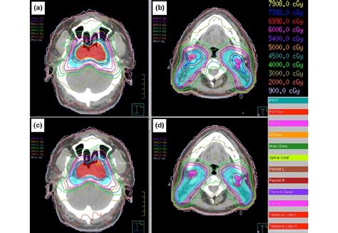 Optimizing Mlc Leaf Speed Could Improve Radiotherapy Plan Quality Physics World