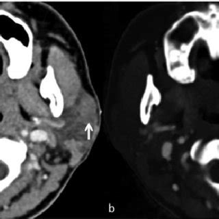 Large Parotid Abscess A The Coronal Contrastenhanced CT Image Shows