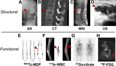 Osteomyelitis Bone Scan