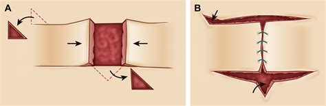 Flap Basics II Facial Plastic Surgery Clinics