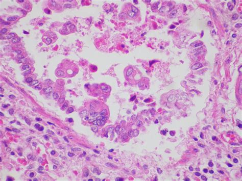 Respiratory Syncytial Virus Rsv Disease Outbreak Control Division