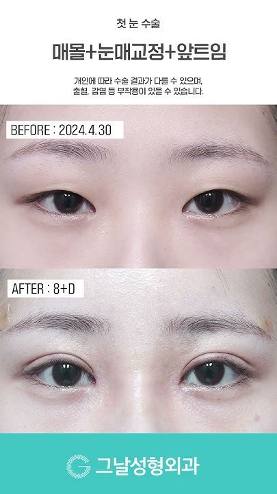 눈이 이렇게 예뻐진다고 Shorts 그날성형외과 강남성형외과추천 강남성형외과 눈수술 눈수술후기 여자눈수술 절개 앞트임 눈매교정 쌍꺼풀수술 쌍수