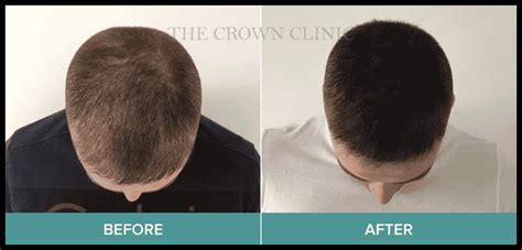 Scalp Micropigmentation Sydney Hair Loss Solutions