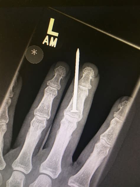 Foreign Body Removal Dallas Hand Surgeon Dr Azouzazouz Hand Surgery