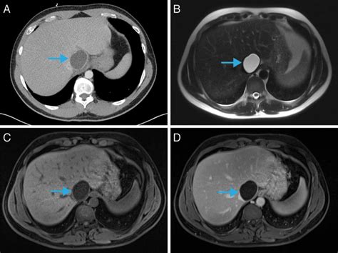 Echinococcosis Ct Cmdt Media Library Accessmedicine Mcgraw Hill Medical