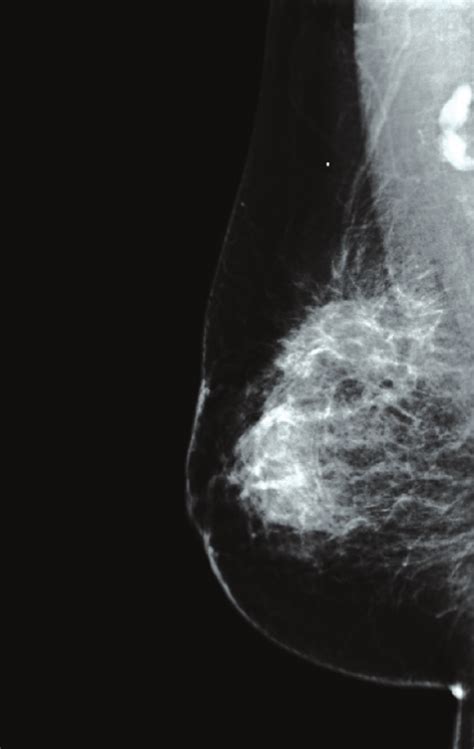 Tc 99m Tetrofosmin Showing Abnormal Uptake In The Right Breast Grey Download High Quality