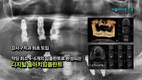 풀아치임플란트 소수의 임플란트로 전체치아 복원 서울라이프치과 네이버 Tv